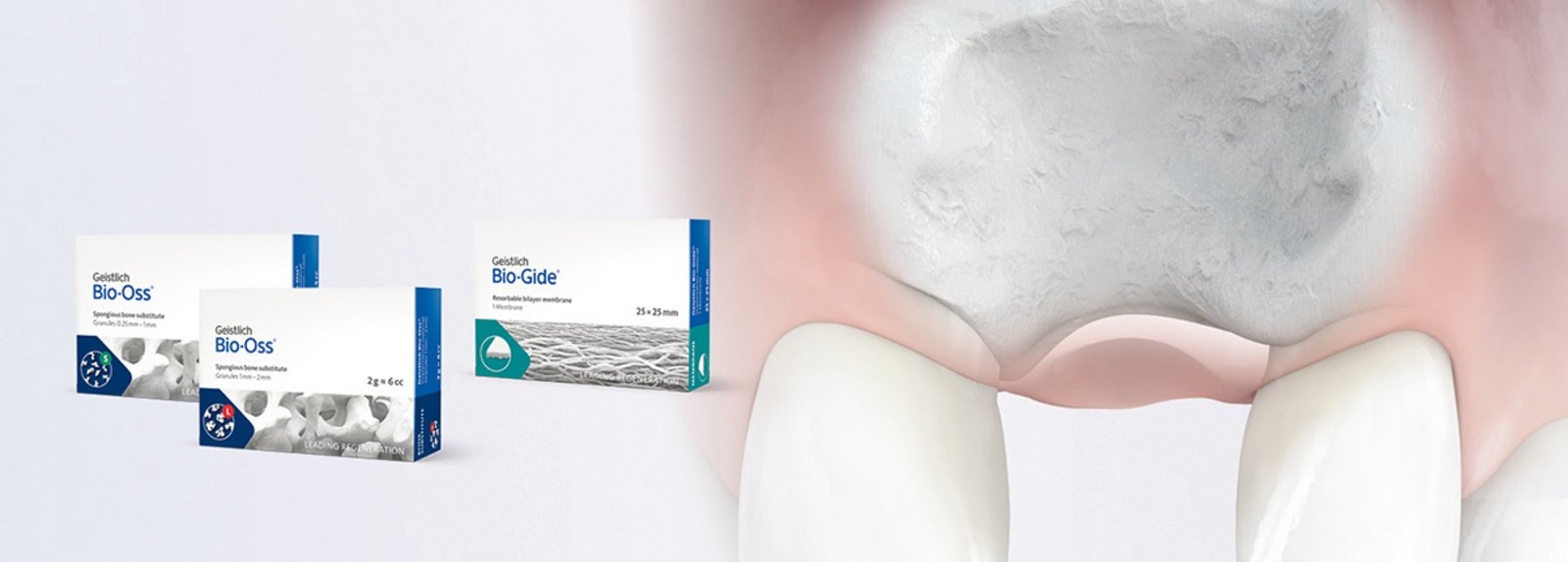 Major Bone Augmentation - Geistlich Pharma AG
