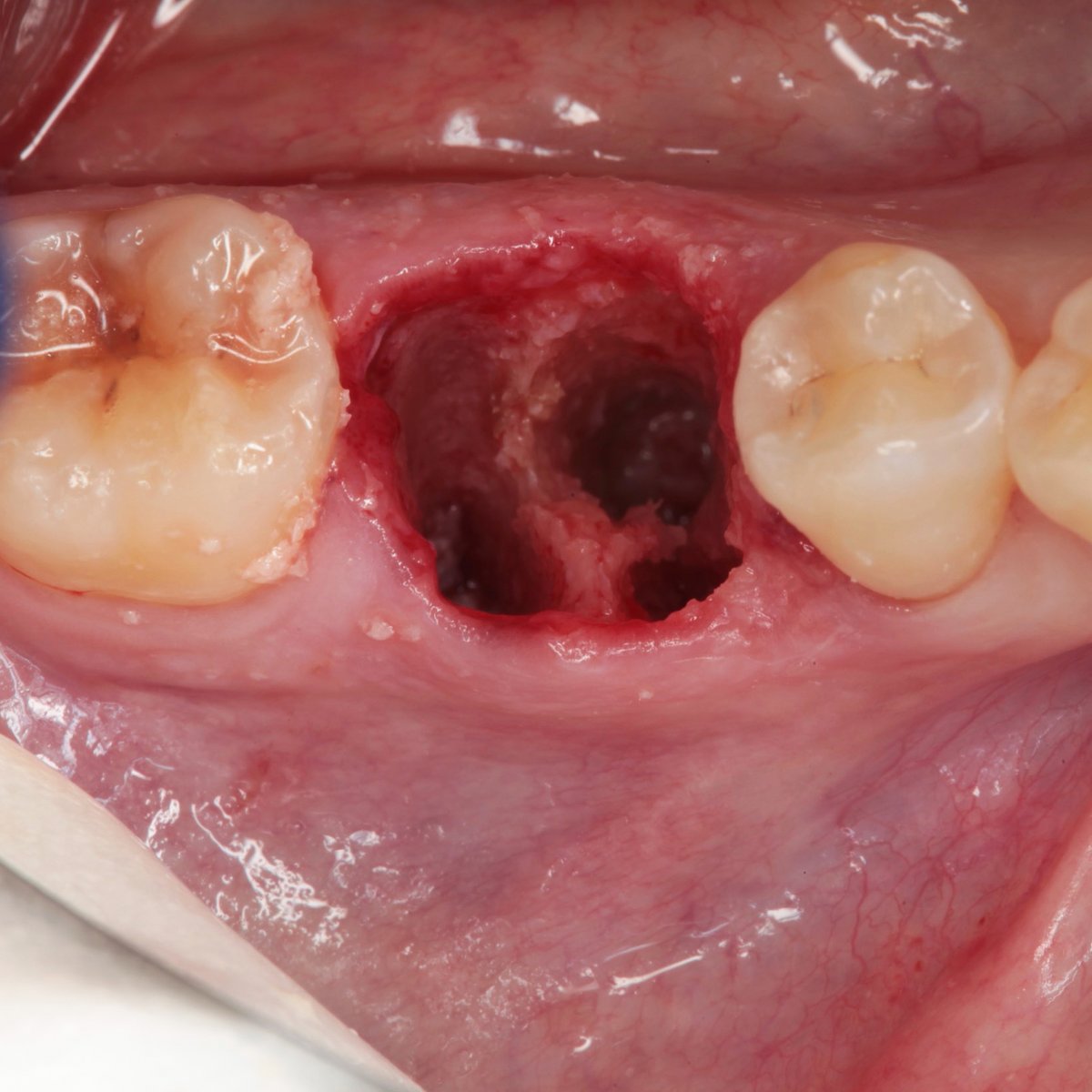 Fractured molar – an immediate transition - Geistlich Pharma AG