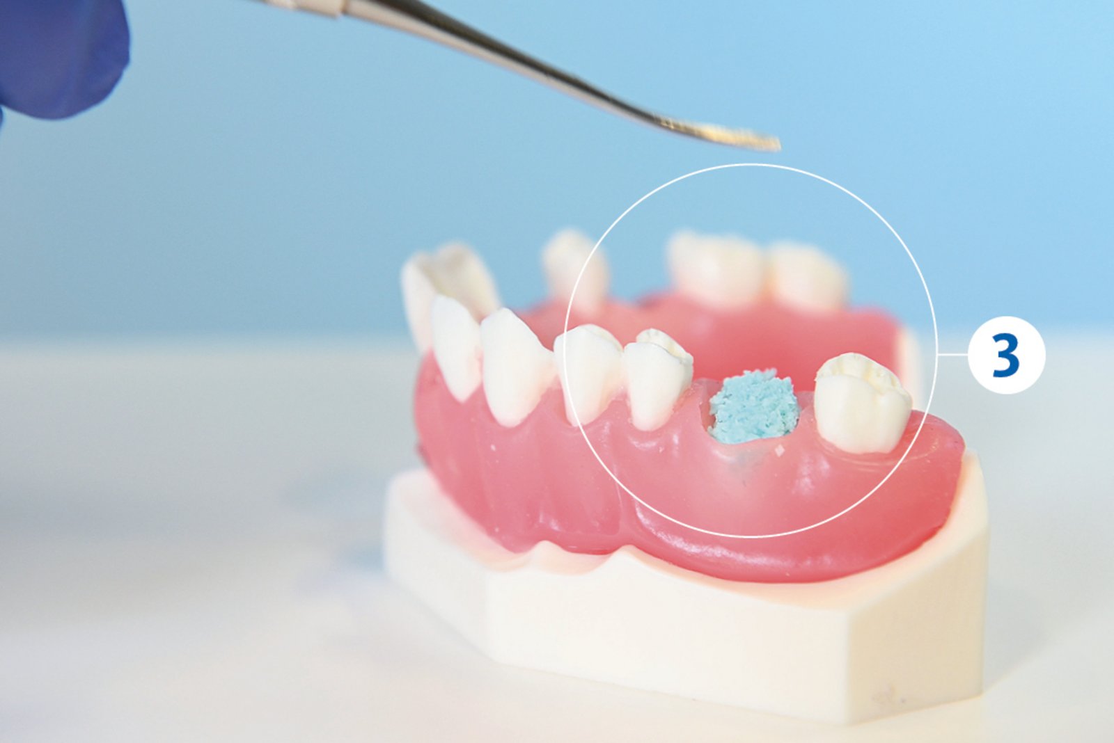 Geistlich Bio-Oss Pen - Geistlich Pharma AG