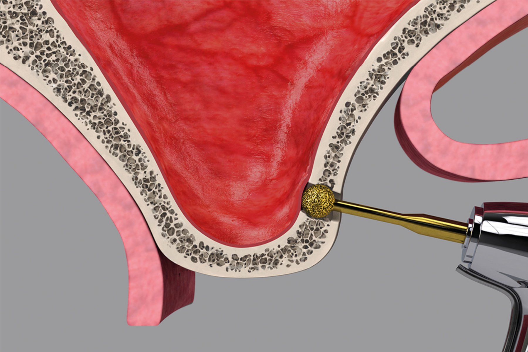 Sinus Floor Elevation - Geistlich Pharma AG