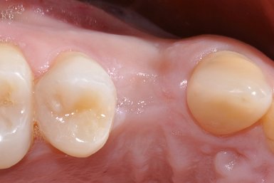 Early implant placement after Ridge Preservation - Geistlich Pharma AG