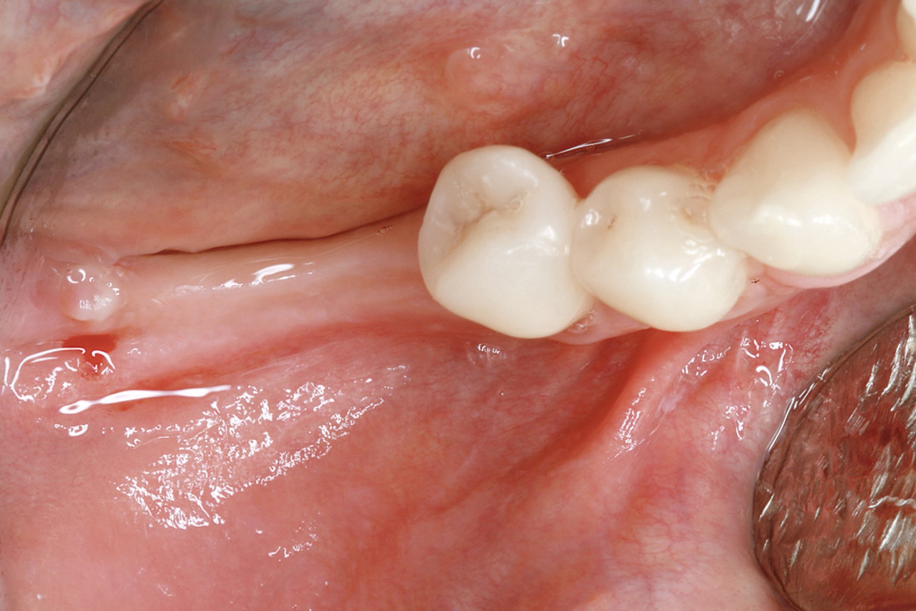 Major Bone Augmentation - Geistlich Pharma AG