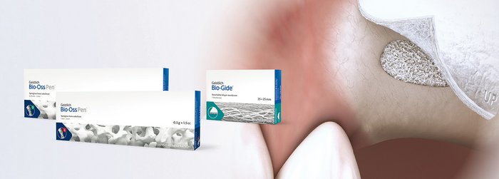 Lateral Sinus Floor Elevation - Geistlich Pharma AG
