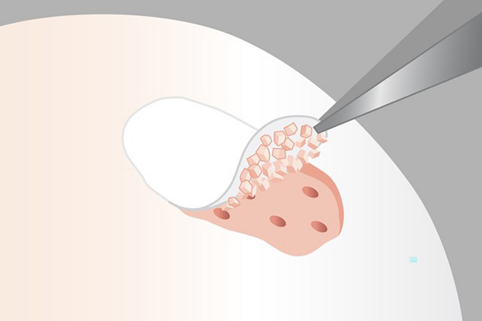 Knorperlregeneration - Geistlich Pharma AG
