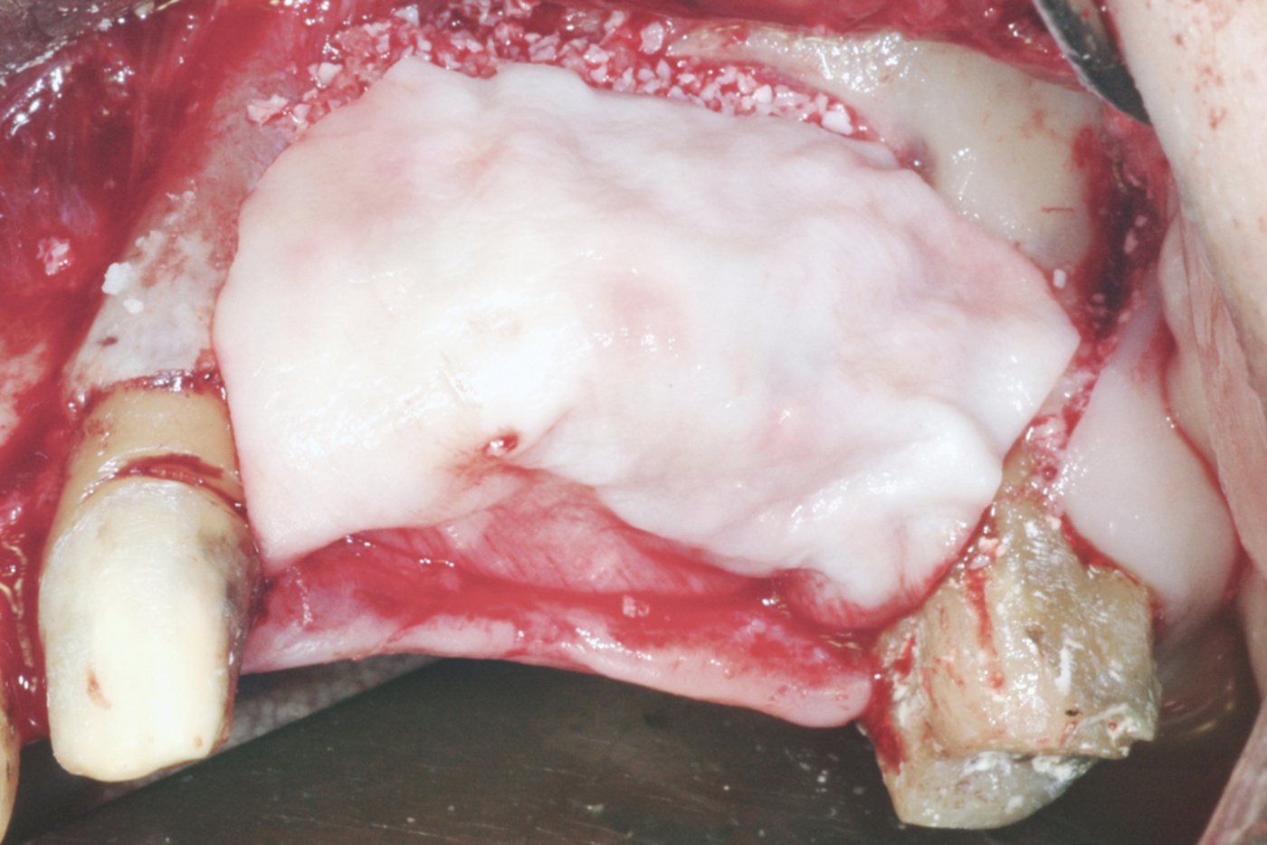 Major Bone Augmentation - Geistlich Pharma AG