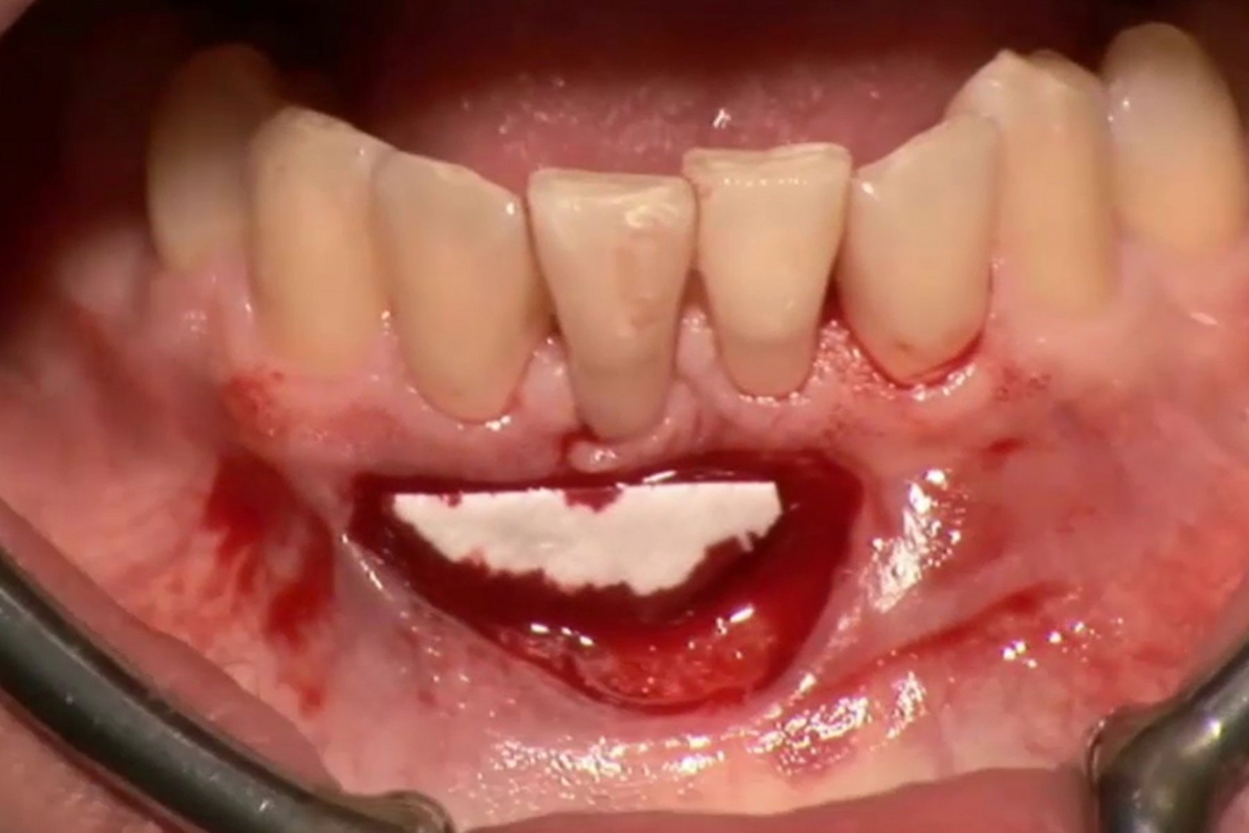 Geistlich Mucograft® - Geistlich Pharma AG