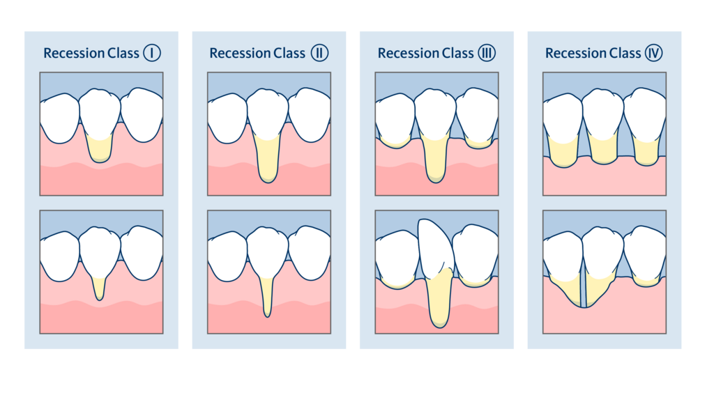 Receding gums - Geistlich Pharma AG
