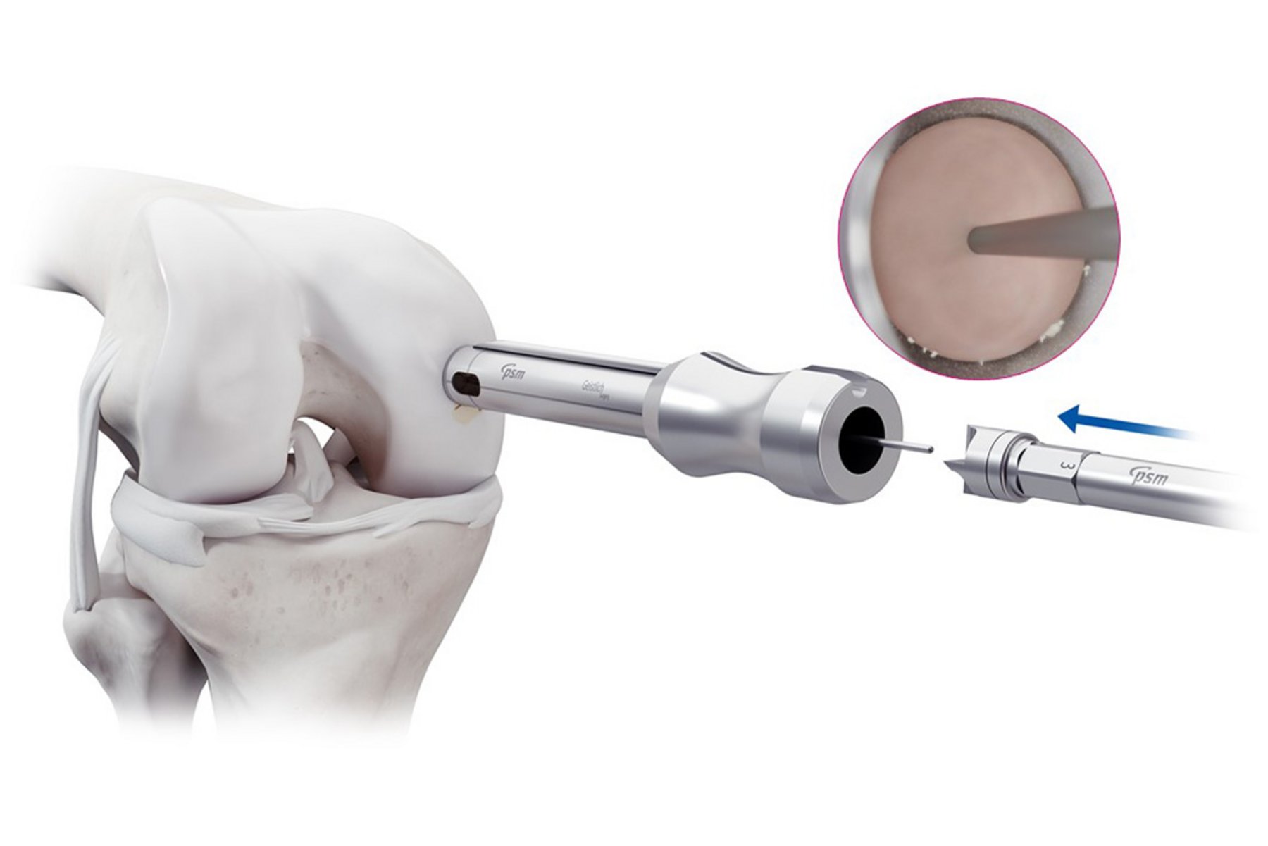 AMIC arthroscopic instruments - Geistlich Pharma AG