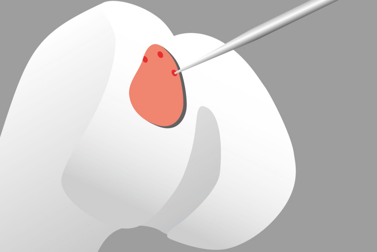 AMIC Chondro-Gide - Geistlich Pharma AG