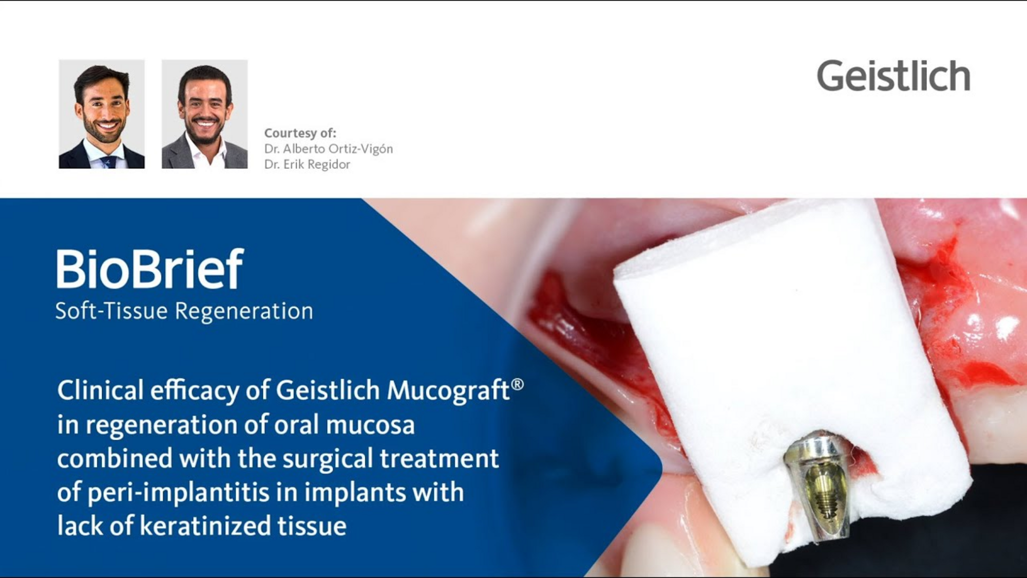 Geistlich Mucograft® for keratinized tissue deficiency and peri ...
