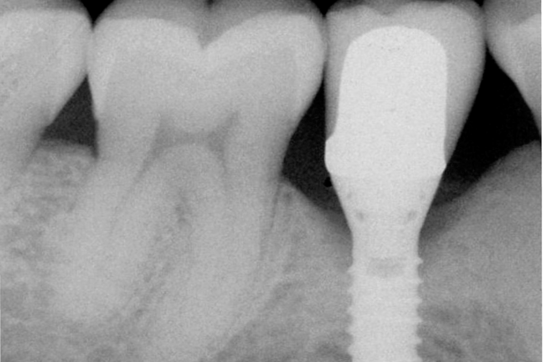 Peri-Implantitis - Geistlich Pharma AG
