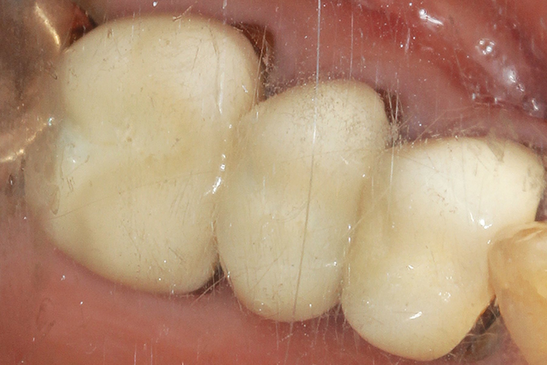 Prevention of Sinus Floor Augmentation - Geistlich Pharma AG