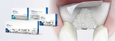 Minor Bone Augmentation - Geistlich Pharma AG