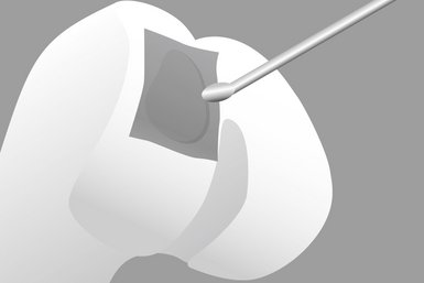 AMIC Chondro-Gide - Geistlich Pharma AG