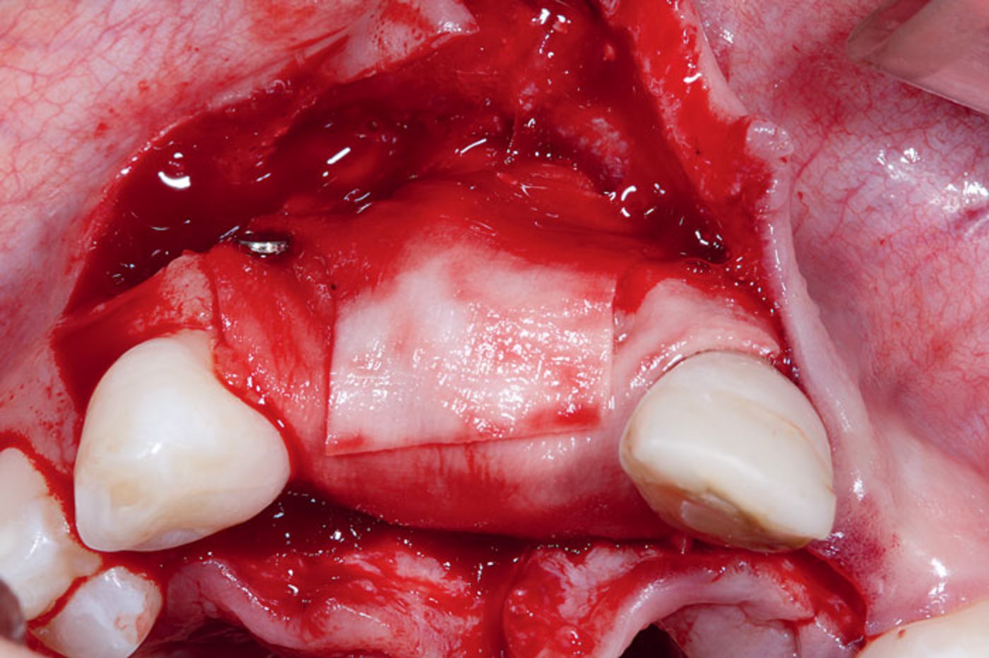 SafeScraper TWIST - Geistlich Pharma AG