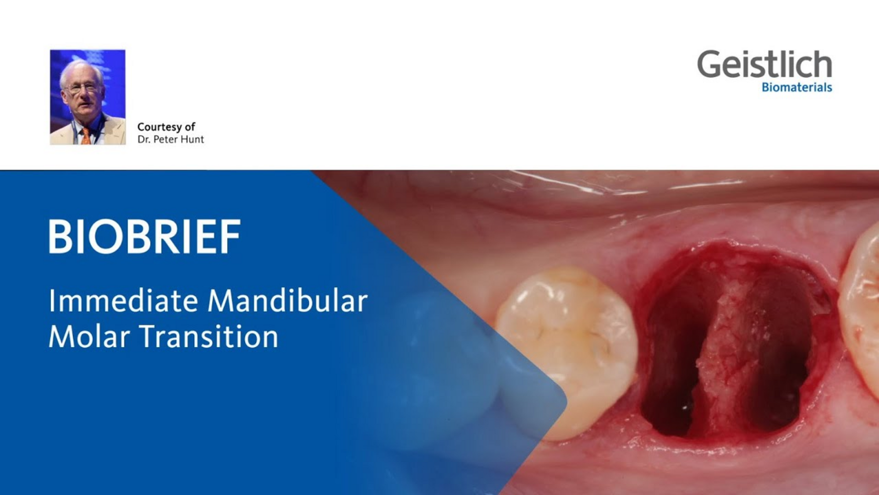 Fractured molar – an immediate transition - Geistlich Pharma AG