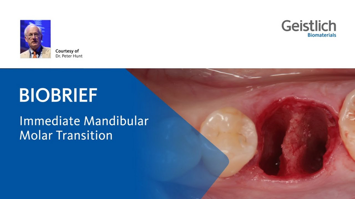 Fractured molar – an immediate transition - Geistlich Pharma AG