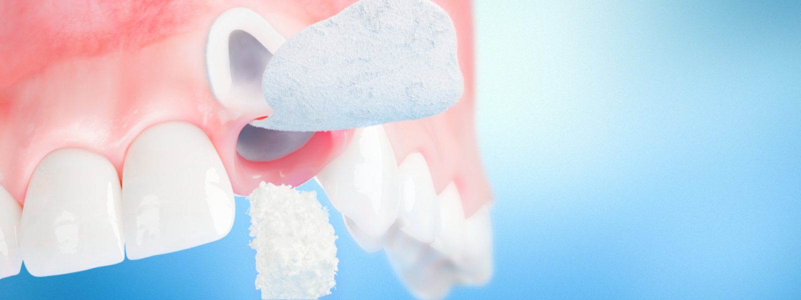 Ridge Preservation - Geistlich Pharma AG