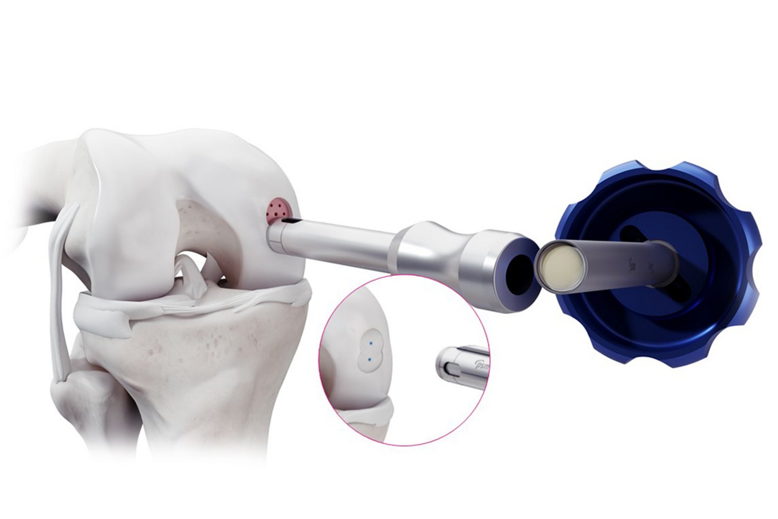 AMIC arthroscopic instruments - Geistlich Pharma AG