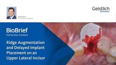 Ridge augmentation in delayed implant placement - Geistlich Pharma AG