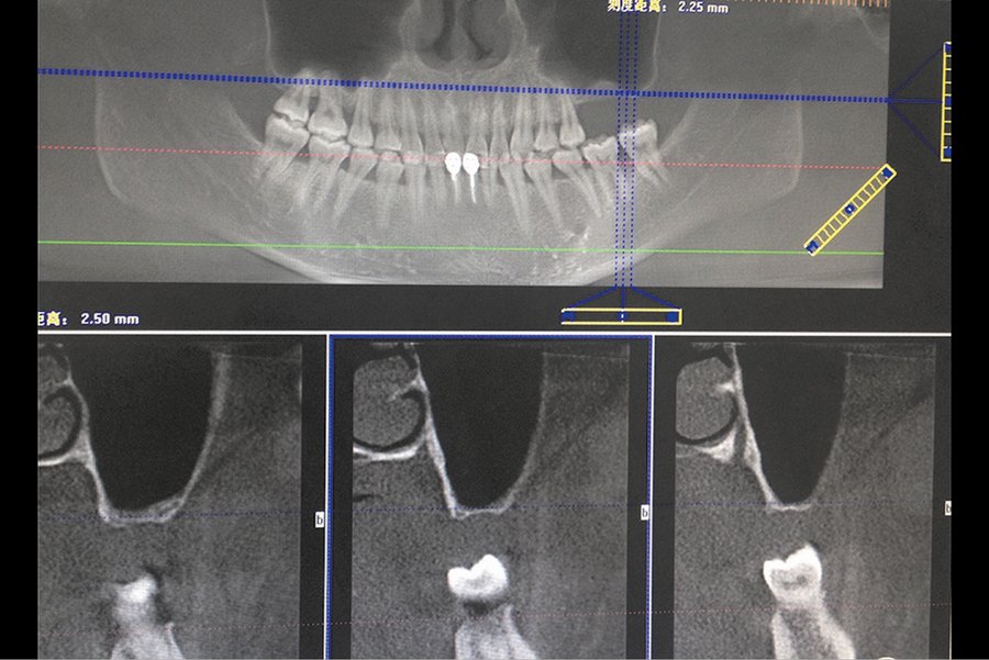 Crestal Sinus Floor Elevation - Geistlich Pharma AG