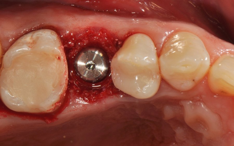 Open healing of extraction sockets with Geistlich Bio-Gide® - Geistlich ...