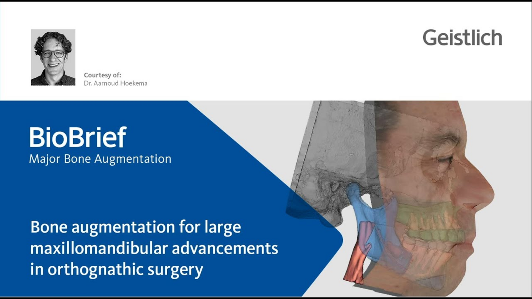 Bone augmentation in orthognathic surgery - Geistlich Pharma AG