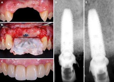 3 Key protocols for horizontal and vertical bone defects - Geistlich ...