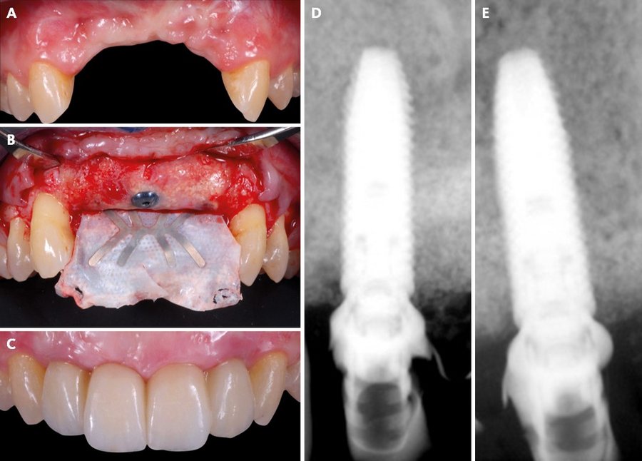 3 Key protocols for horizontal and vertical bone defects - Geistlich Pharma AG