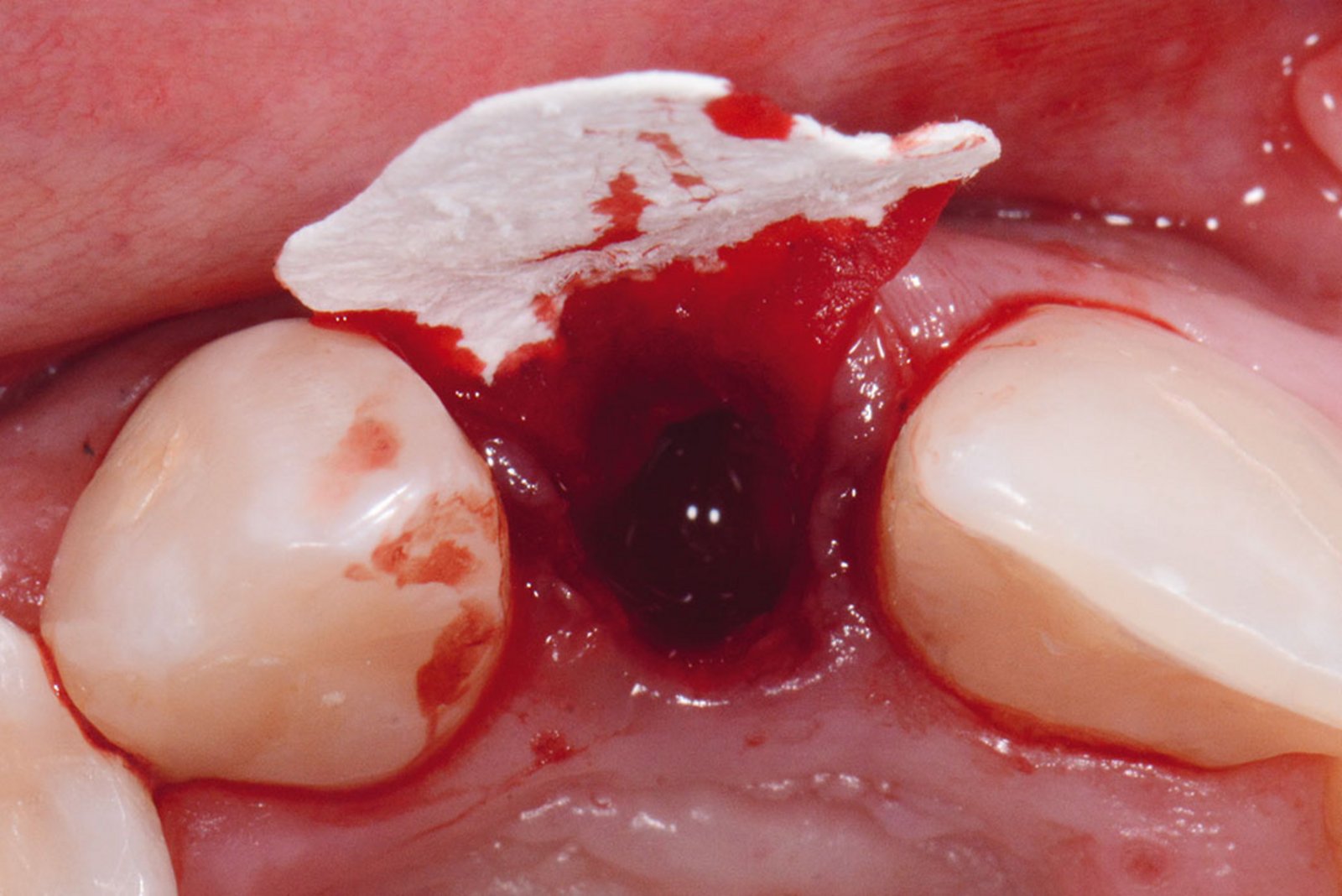 Geistlich Bio-Gide Shape - Geistlich Pharma AG