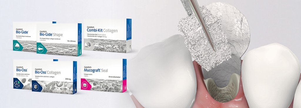 Extraction Socket Management - Geistlich Pharma AG