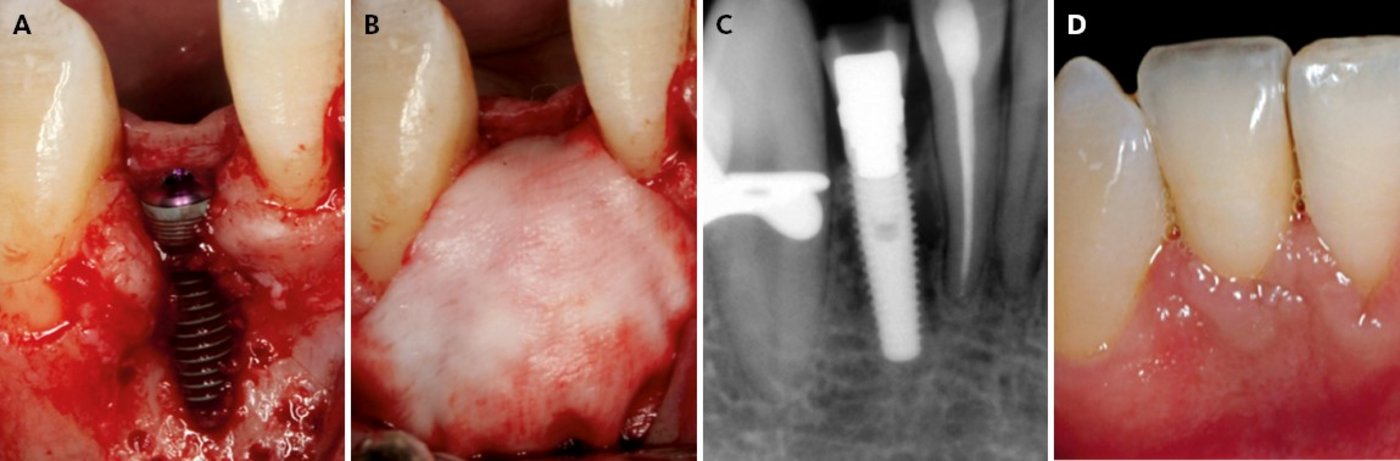 3 Key protocols for horizontal and vertical bone defects - Geistlich ...