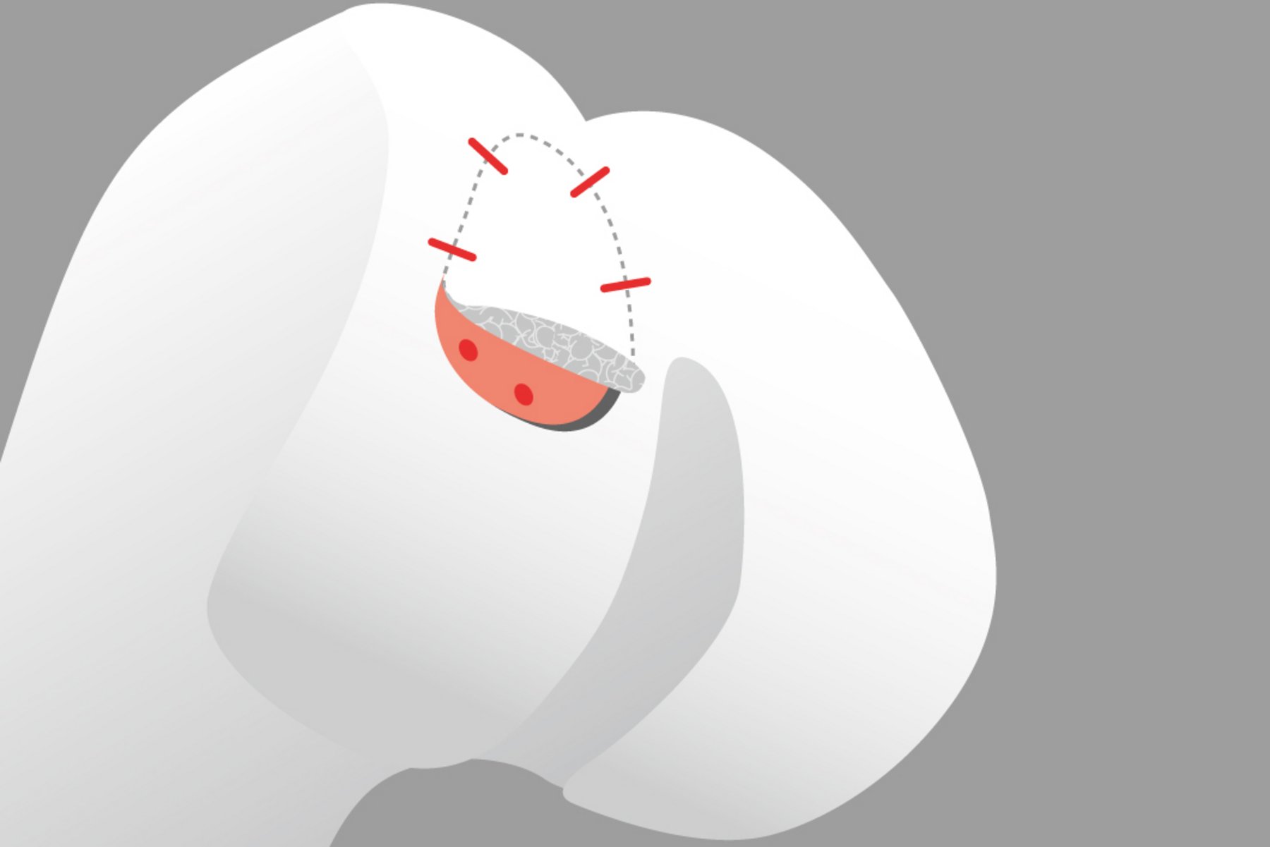 AMIC Chondro-Gide - Geistlich Pharma AG