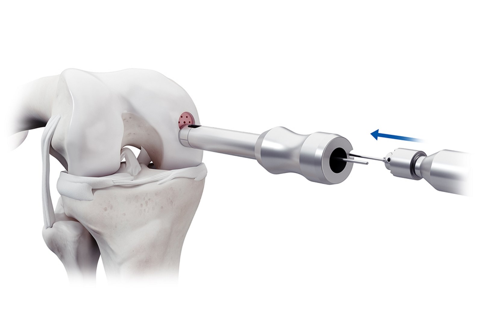 AMIC arthroscopic instruments - Geistlich Pharma AG