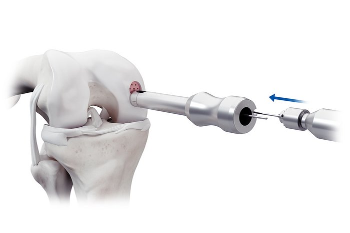 AMIC arthroscopic instruments - Geistlich Pharma AG