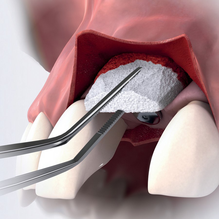 GEM21S - Geistlich Pharma AG
