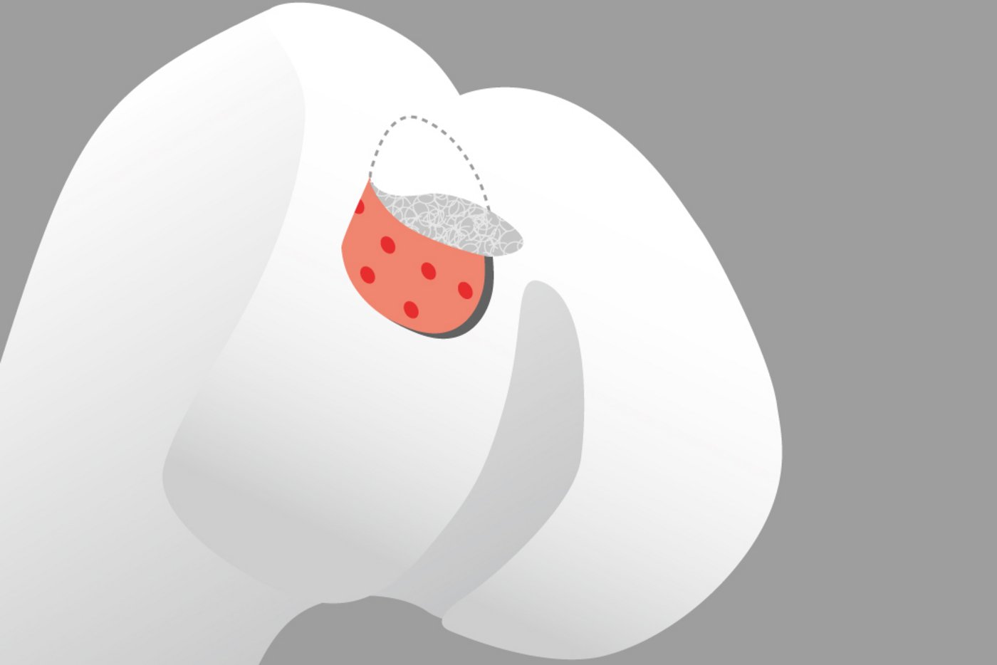 AMIC Chondro-Gide - Geistlich Pharma AG