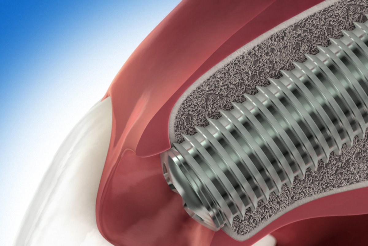 Minor Bone Augmentation - Geistlich Pharma AG