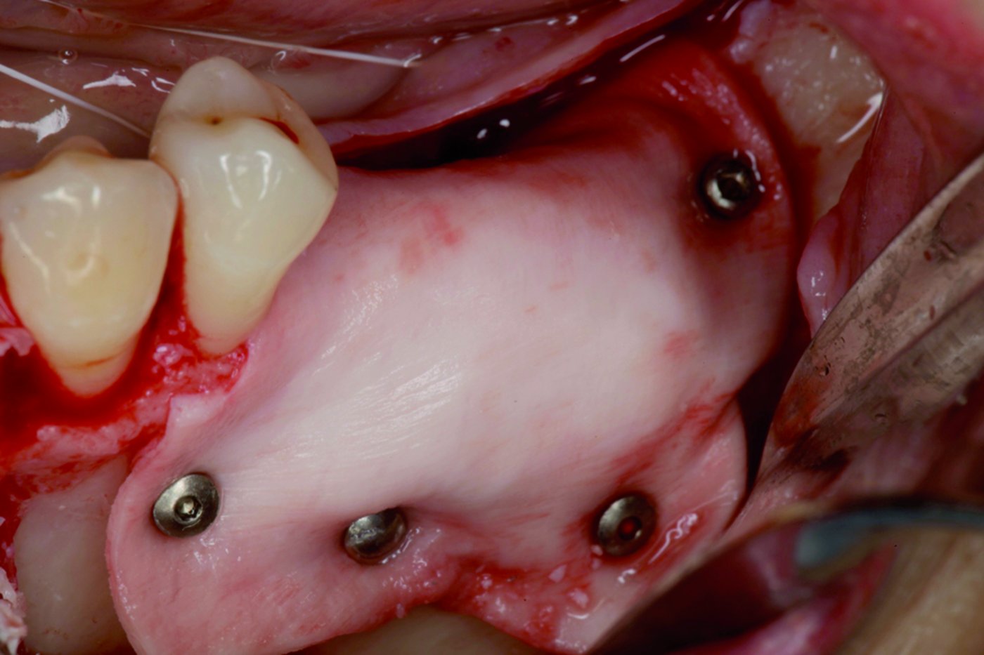 Meisinger Bone Management - Geistlich Pharma AG