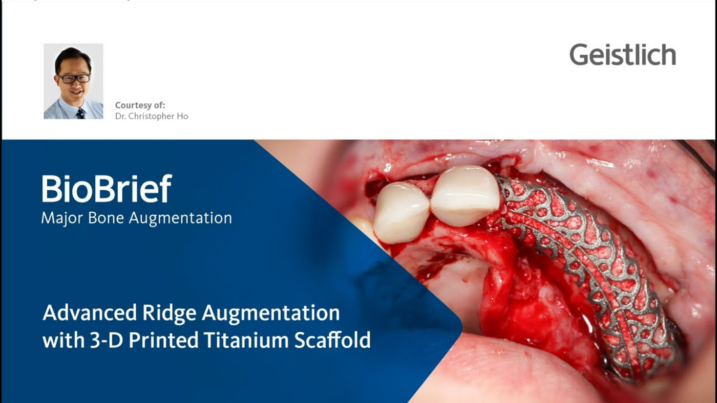 Advanced ridge augmentation with 3D printed titanium scaffold ...