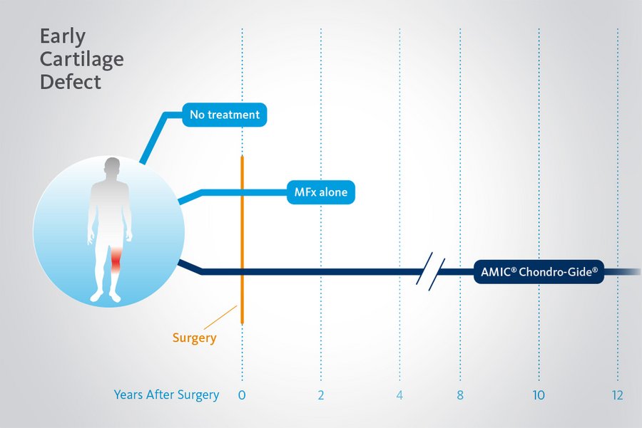AMIC Knee - Geistlich Pharma AG