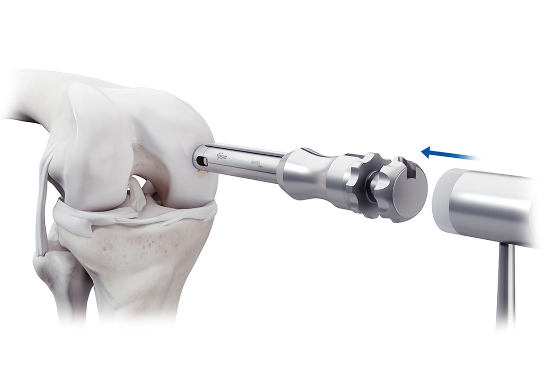 AMIC arthroscopic instruments - Geistlich Pharma AG