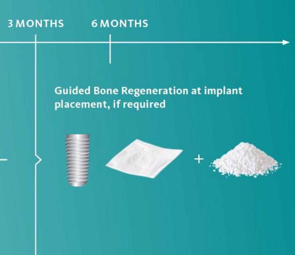 Extraction Socket Management - Geistlich Pharma AG