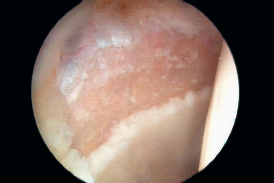 AMIC Hip - Geistlich Pharma AG