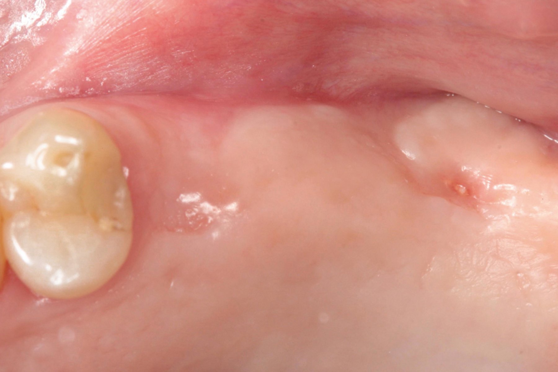 Socket Seal - Geistlich Pharma AG