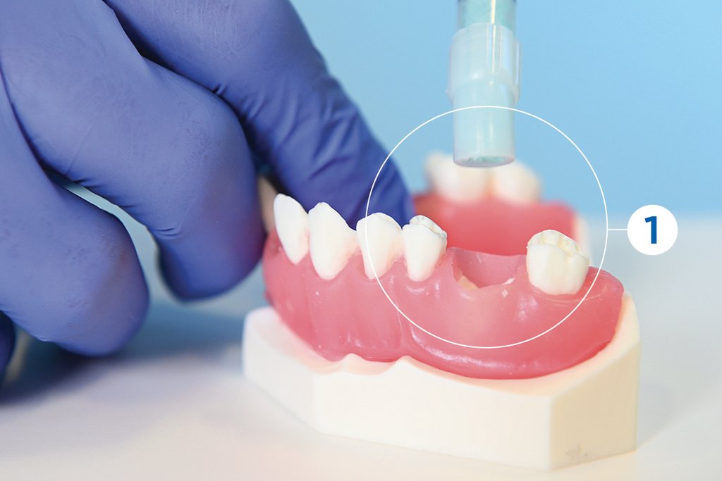Geistlich Bio-Oss Pen - Geistlich Pharma AG