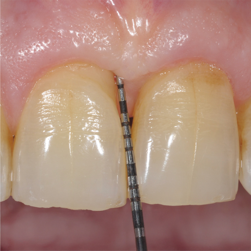 REGENFAST® in the treatment of infrabony defects - Geistlich Pharma AG