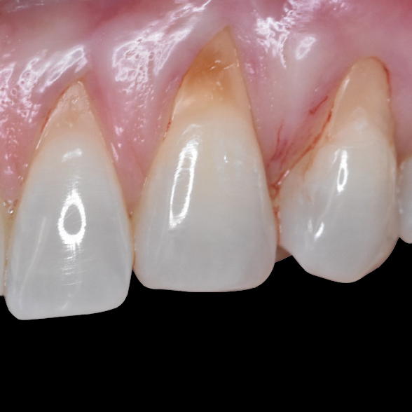 Multiple recession coverage in the maxilla - Geistlich Pharma AG