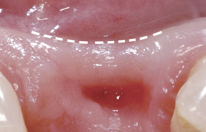 Ridge Preservation - Geistlich Pharma AG