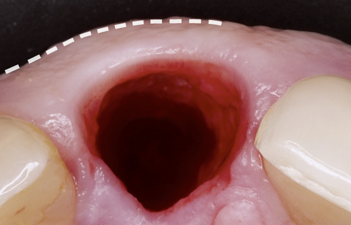 Extraction Socket Management - Geistlich Pharma AG